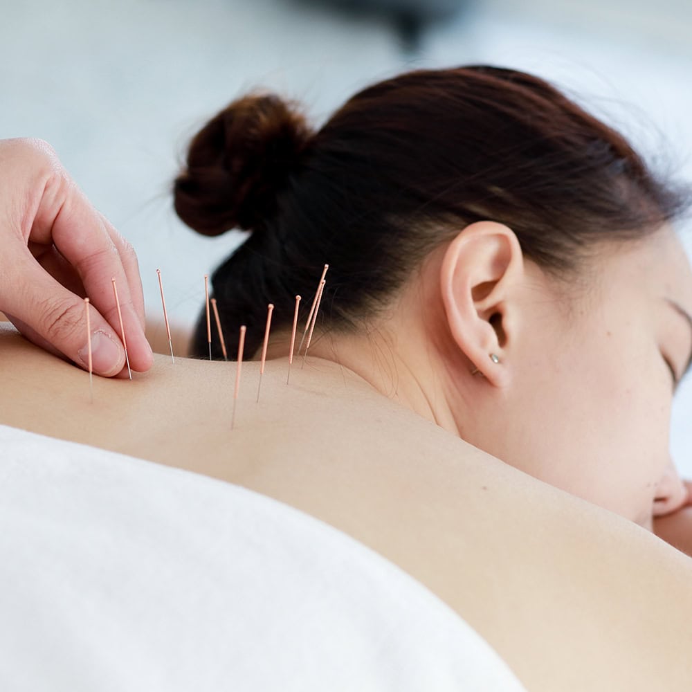 Dry Needling - Troy Family Chiropractic + Wellness